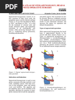 Cricopharyngeal Myotomy Surgical Technique | PDF | Common Carotid ...