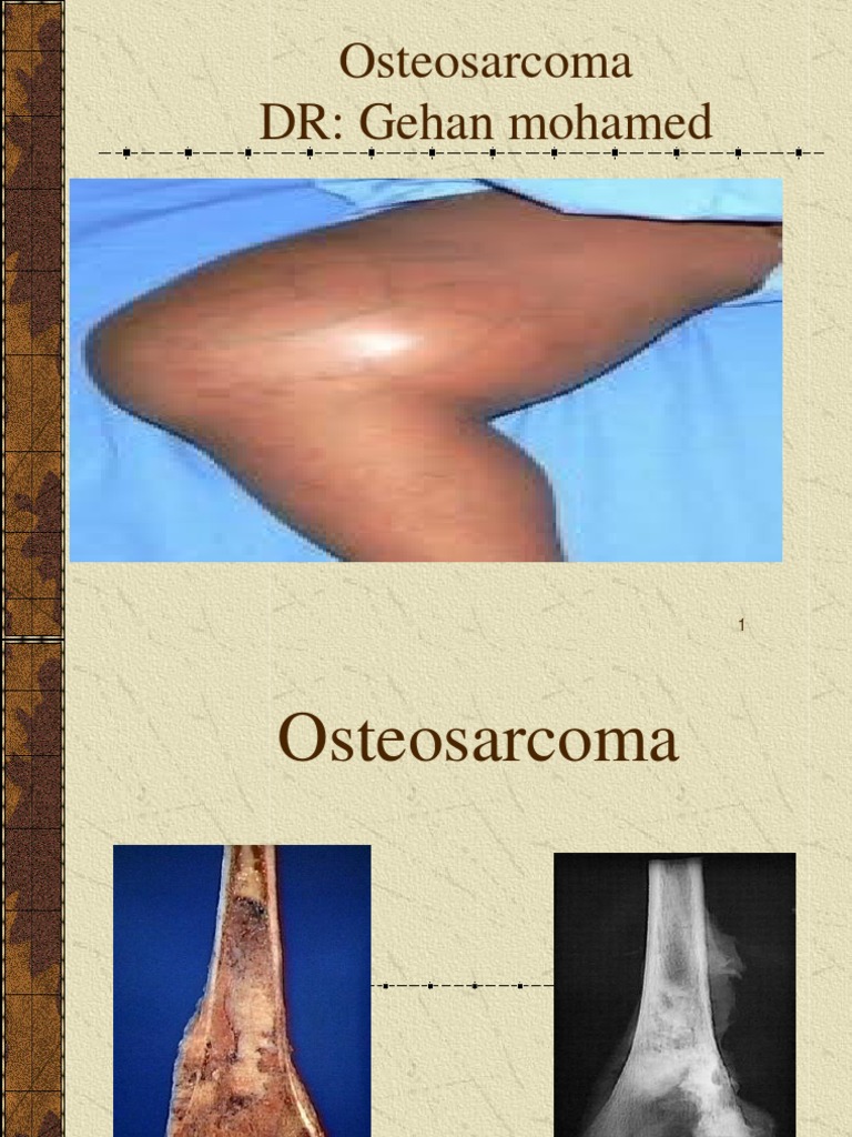 Osteosarcoma DR: Gehan Mohamed | PDF | Neoplasms | Cancer