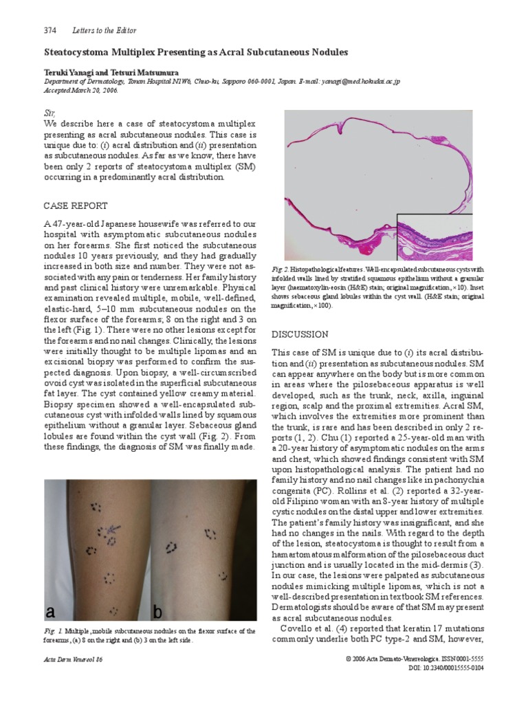Steatocystoma Multiplex Presenting As Acral Subcutaneous Nodules | PDF ...