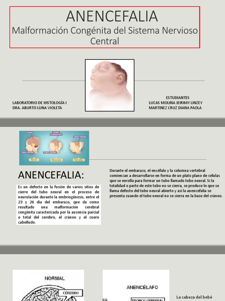 Anencefalia: Causas y Características | PDF | Neurociencia ...