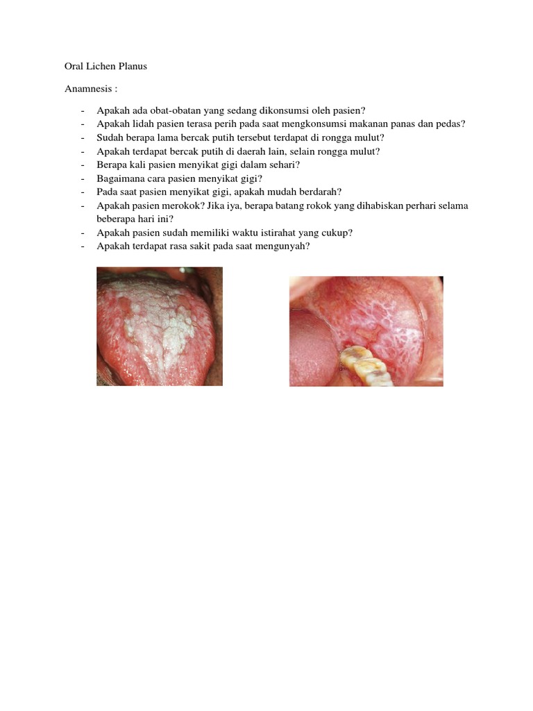 Oral Lichen Planus Dan Leukoedema | PDF | Kesehatan Holistik