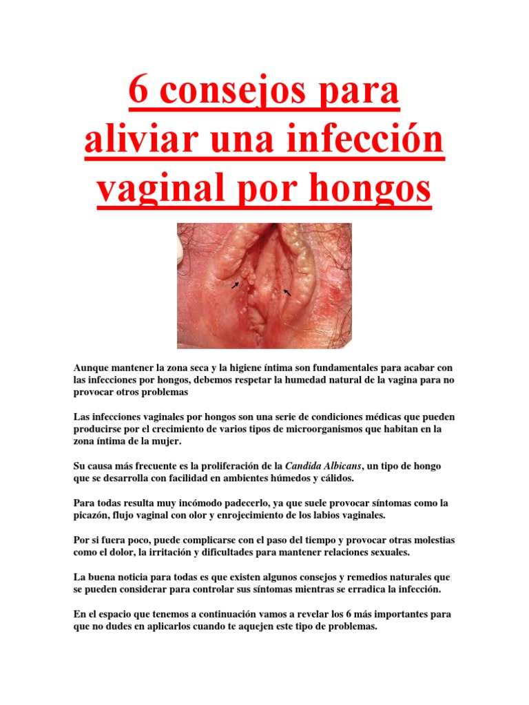 6 Consejos para Aliviar Una Infección Vaginal Por Hongos | PDF ...