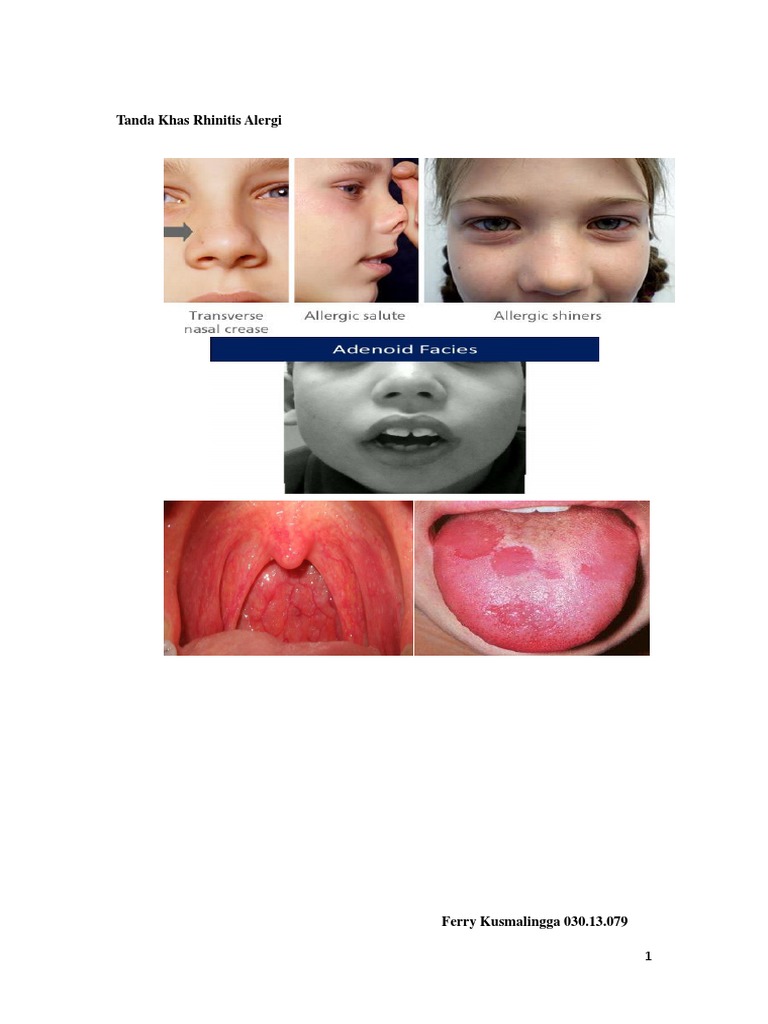 Gejala Rhinitis Alergi | PDF