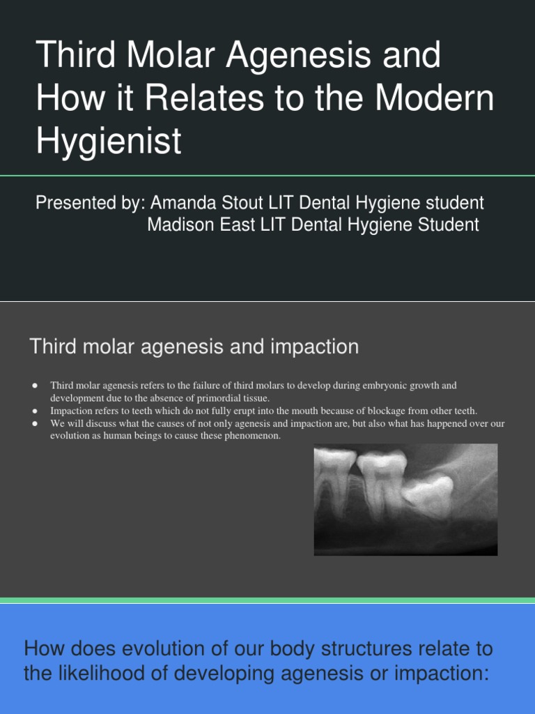 Third Molar Agenesis and How It Relates To The Modern Hygienist | PDF ...