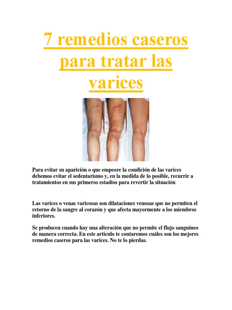 Remedios caseros para varices | PDF | Venas varicosas | Corazón