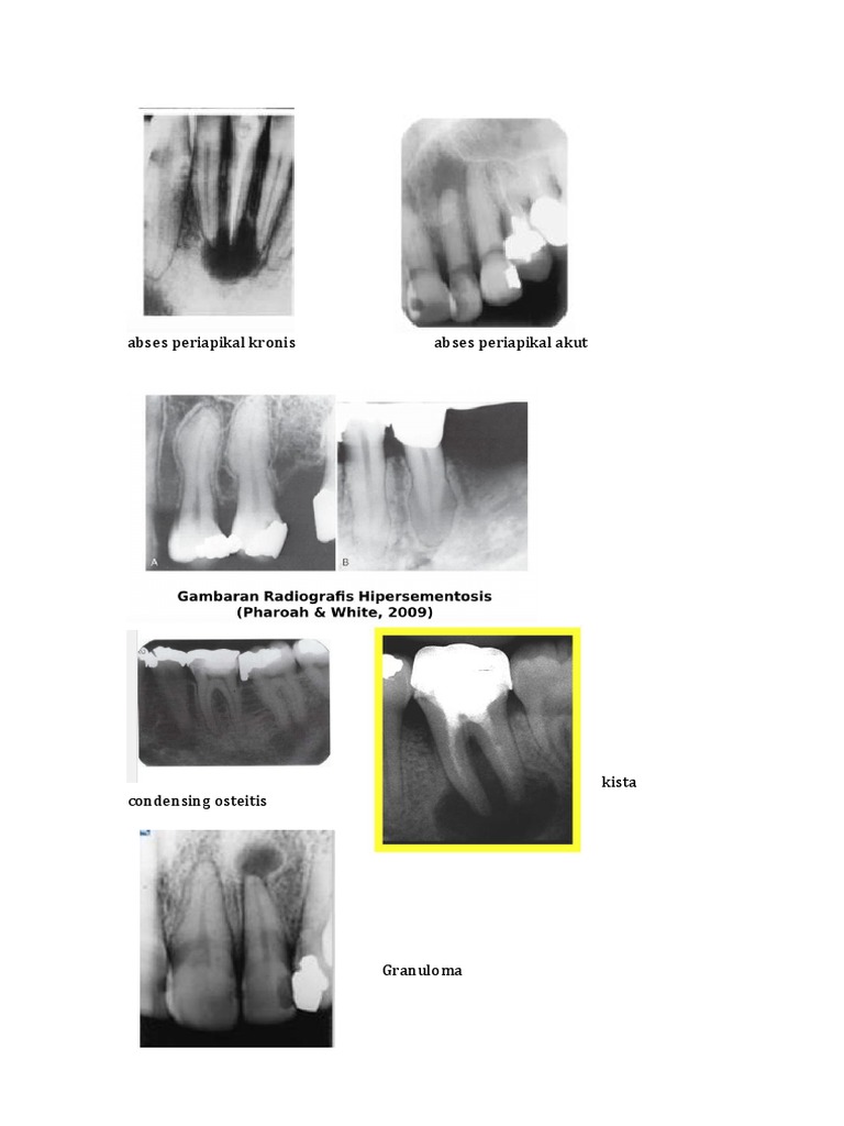 Abses Periapikal Kronis Abses Periapikal Akut | PDF