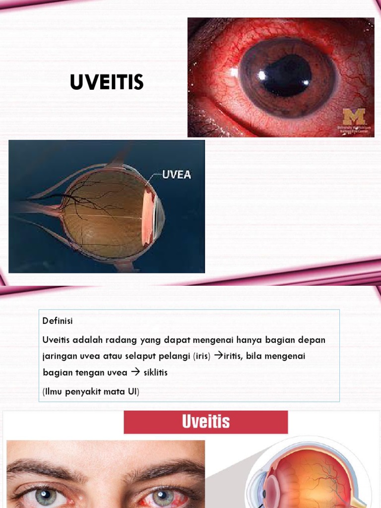 Uveitis: Definisi, Gejala, dan Pengobatan | PDF | Kesehatan Holistik