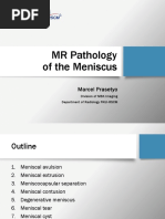 MRI Meniscus Tear Grading Guide | PDF