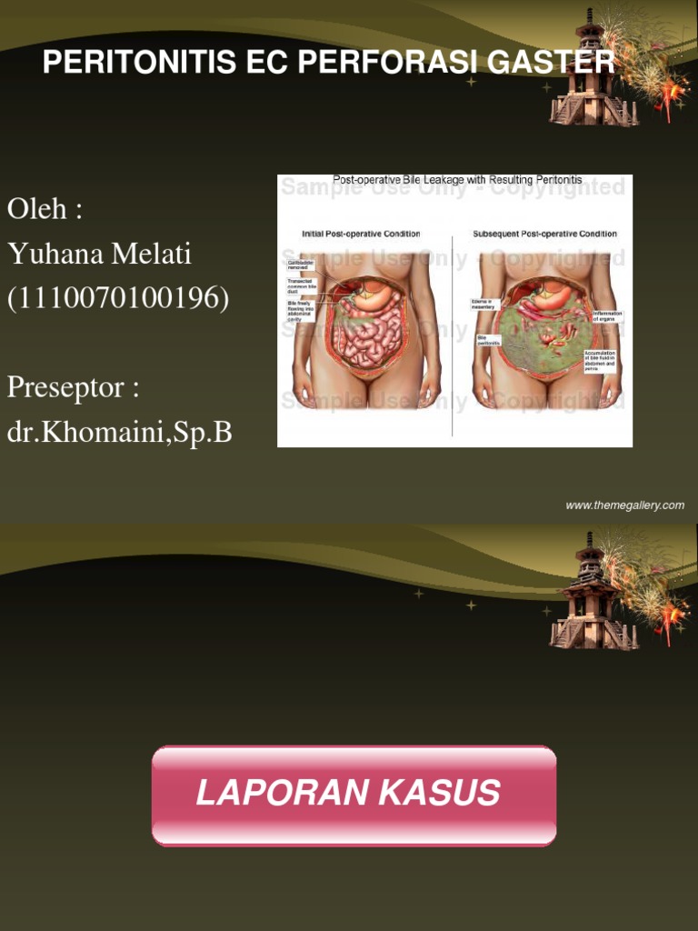 Pptcase Peritonitis Ec Perforasi Gaster | PDF