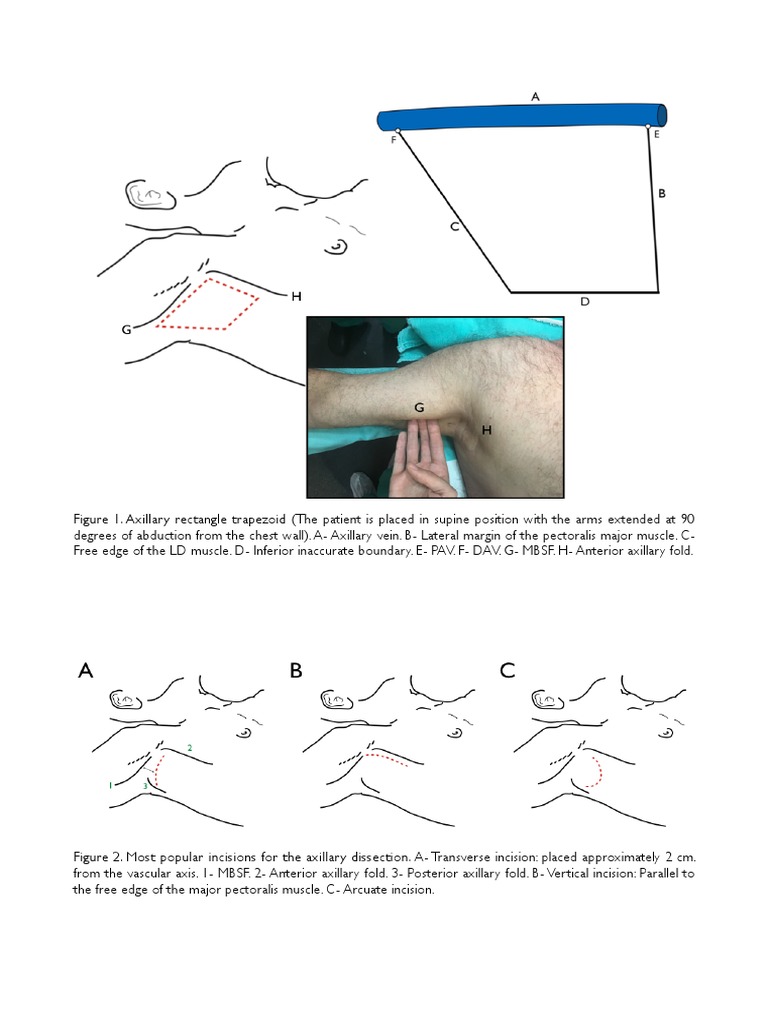 Axillary Dissection Techniques and Anatomy | PDF | Anatomical Terms Of ...