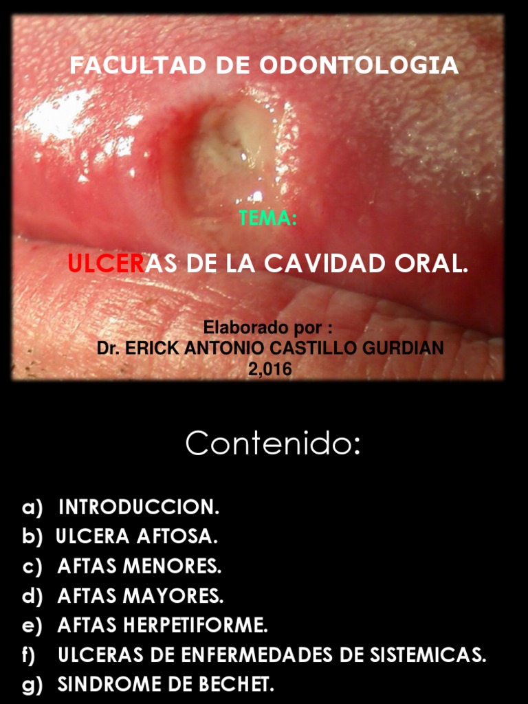 Ulceras de La Cavidad Oral | PDF | Sistema inmune | Ciencias de la Salud