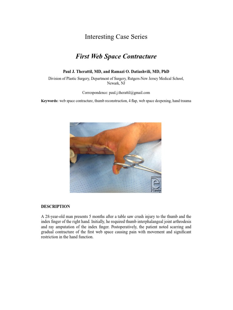 First Web Space Contracture: Interesting Case Series | PDF | Thumb | Finger