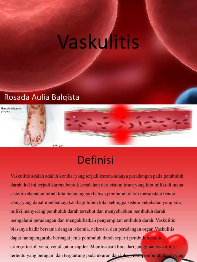 Vaskulitis PPT (Rosada) | PDF