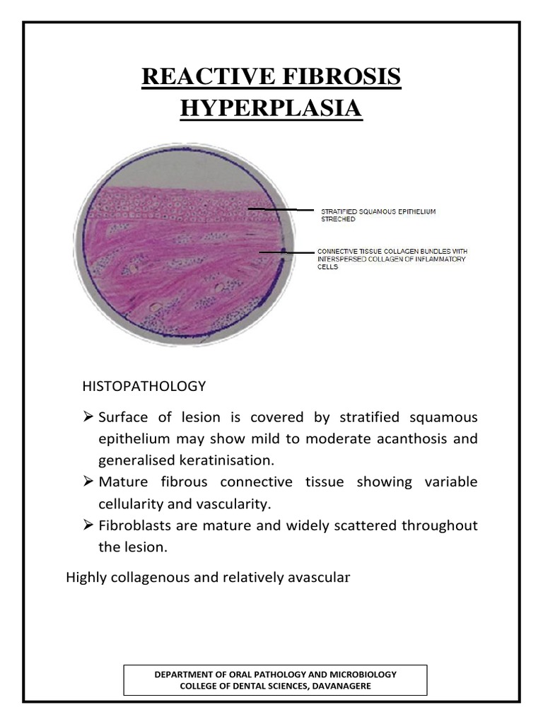 Reactive Fibrosis Hyperplasia Overview | PDF