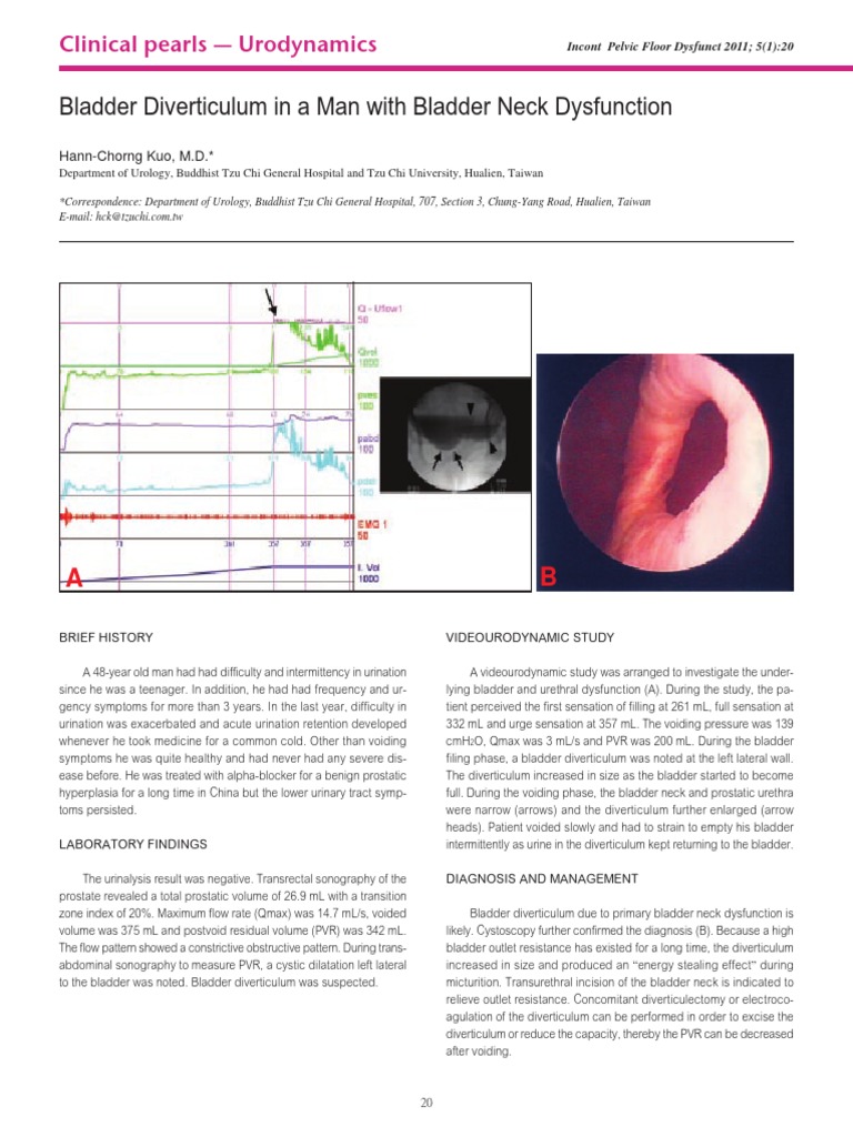 Bladder Diverticulum in A Man With Bladder Neck Dysfunction: Clinical ...