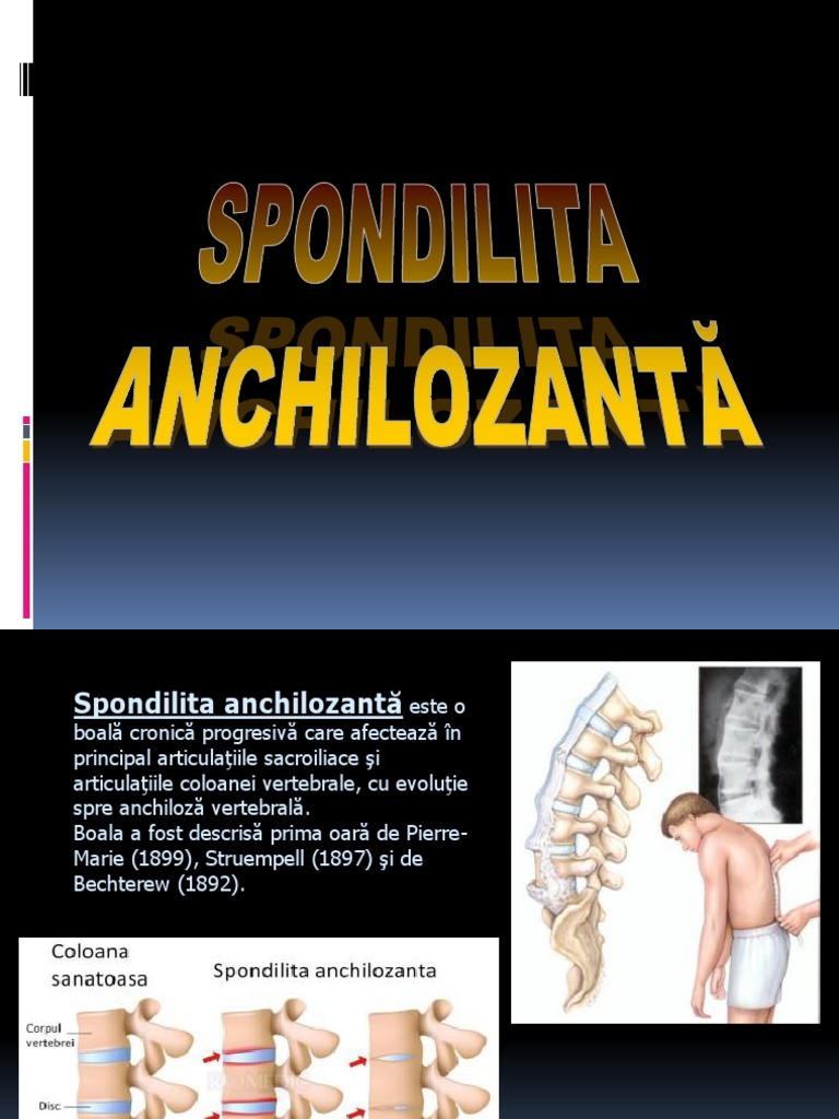 Spondilita | PDF