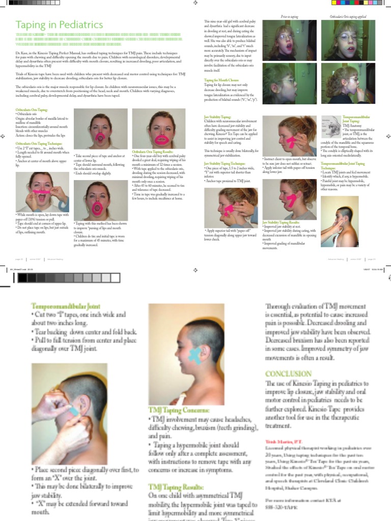 Taping in Pediatrics: Prior To Taping Orbicularis Oris Taping Applied ...