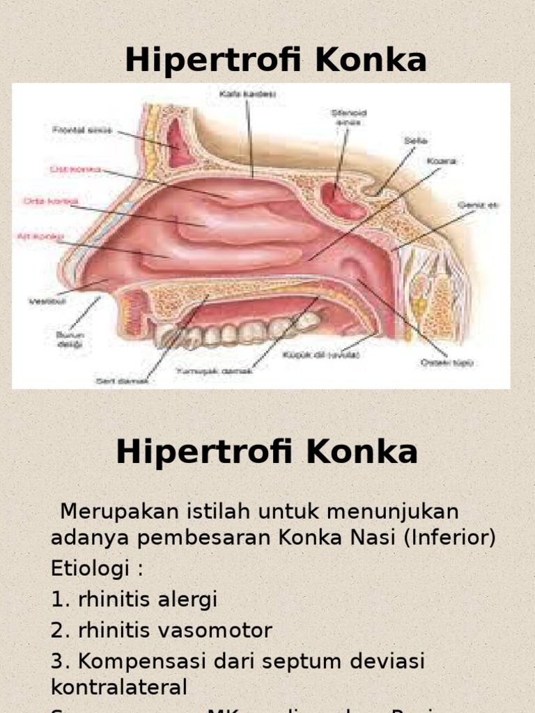 Hipertrofi Konka PDF | PDF