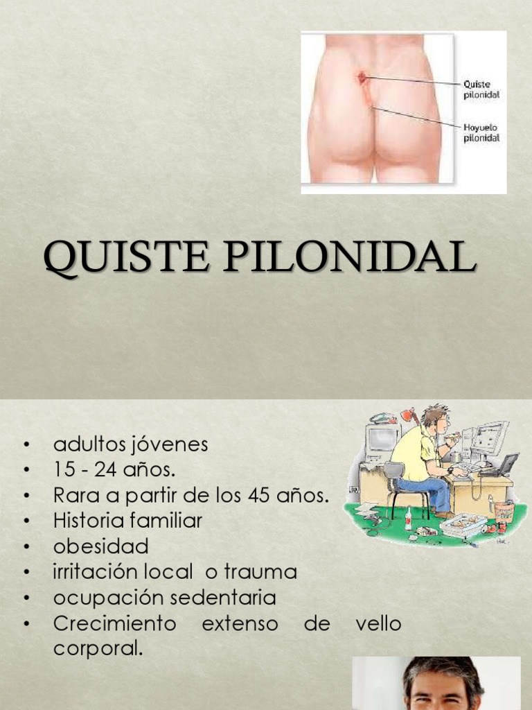 Quiste Pilonidal | PDF | Herida | Epidemiología