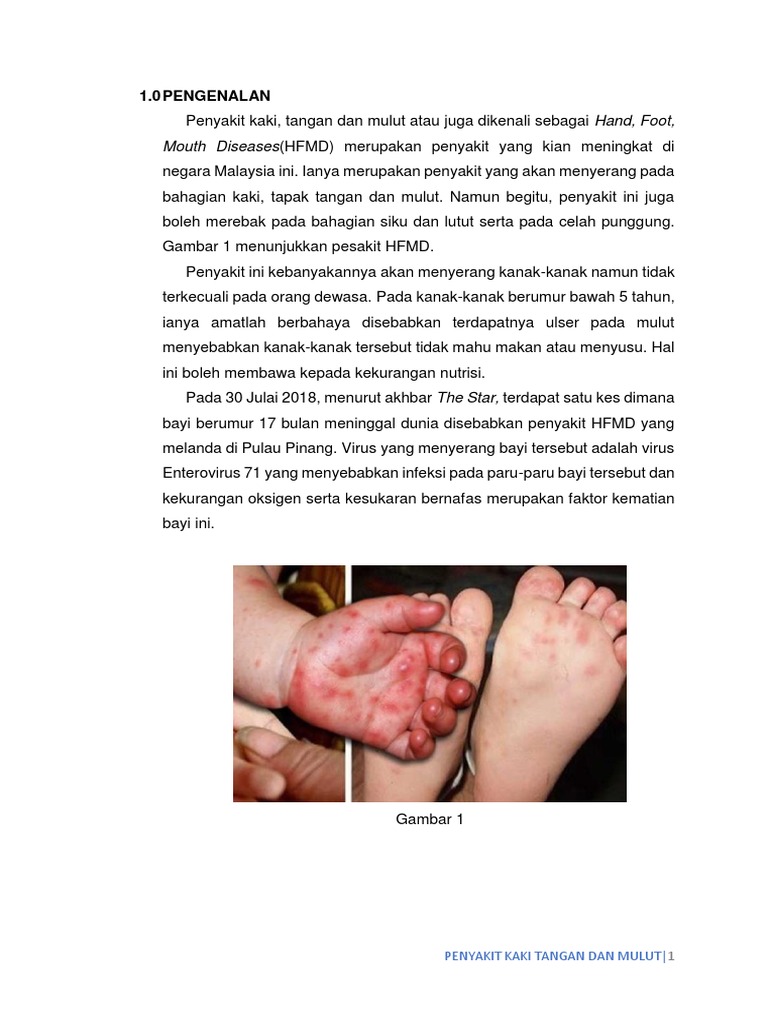 HFMD: Penyebab, Gejala, dan Pencegahan | PDF