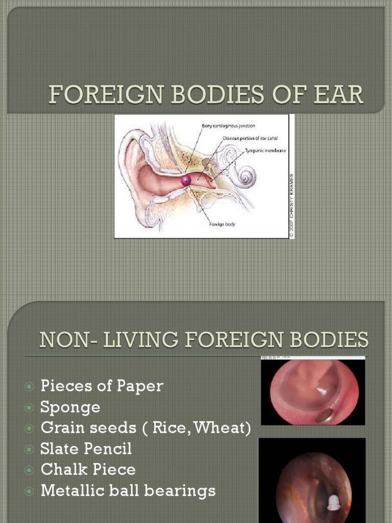 Foreign Bodies of Ear | PDF