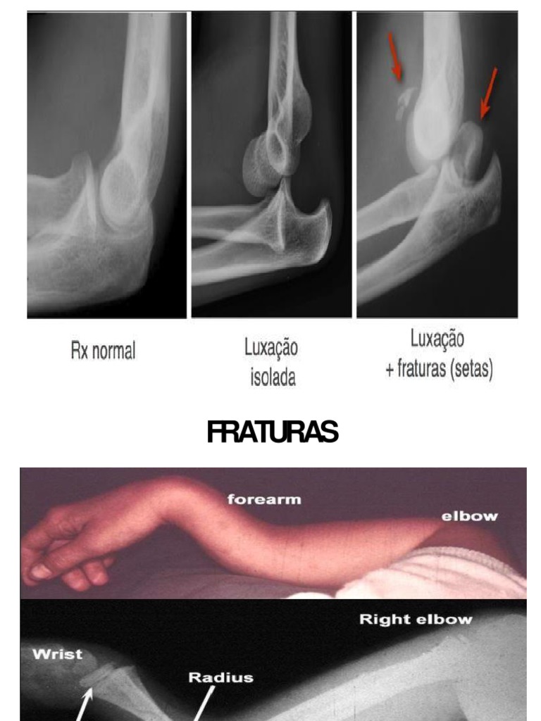 Estudos de Imagens Ortopédicas - Fraturas | Especialidades Médicas ...