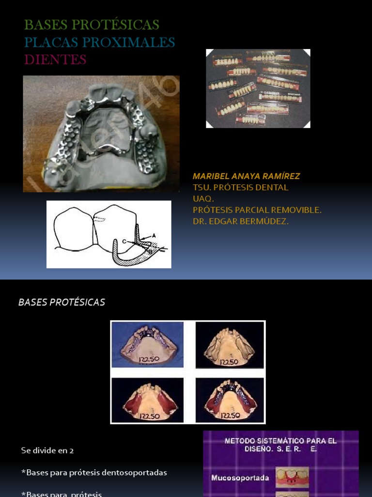 Bases Protesicas Placas Proximales PPR | Dentadura postiza | Ramas de ...