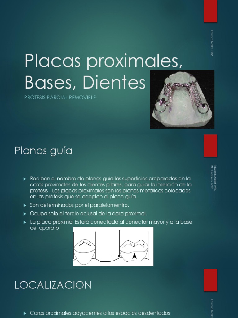 Removible Placas Proximales Planos Guia | Dentadura postiza