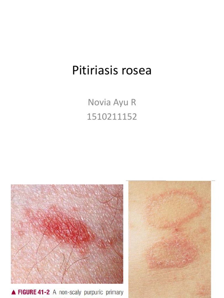 Understanding Pitiriasis Rosea | PDF | Wellness | Science & Mathematics