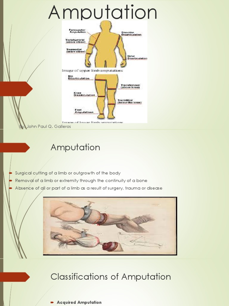 Amputation | PDF | Amputation | Prosthesis