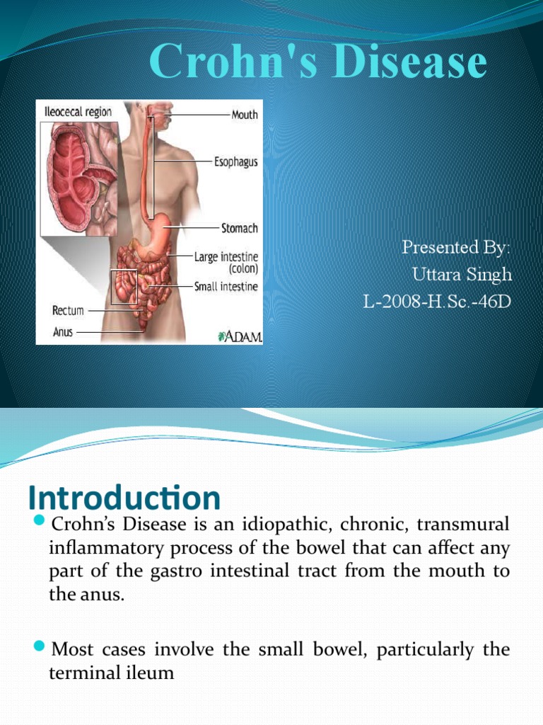 Crohns Disease Ppt