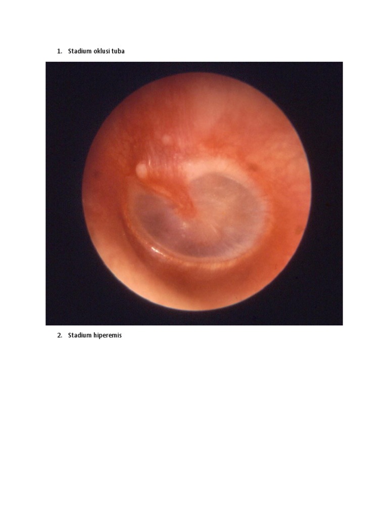 The Five Stages of Middle Ear Infection: From Initial Inflammation to ...