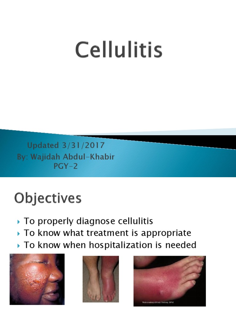 Cellulitis | Methicillin Resistant Staphylococcus Aureus | Infection