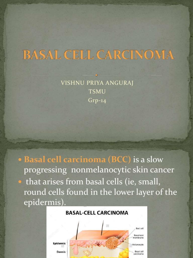 Understanding Basal Cell Carcinoma (BCC) | PDF | Integumentary System ...