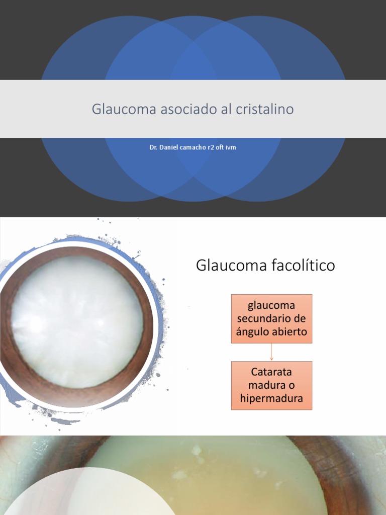 Glaucoma Asociado Al Cristalino | PDF | Glaucoma | Catarata
