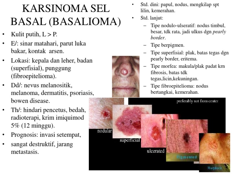 Karsinoma Sel Basal (Basalioma) | PDF