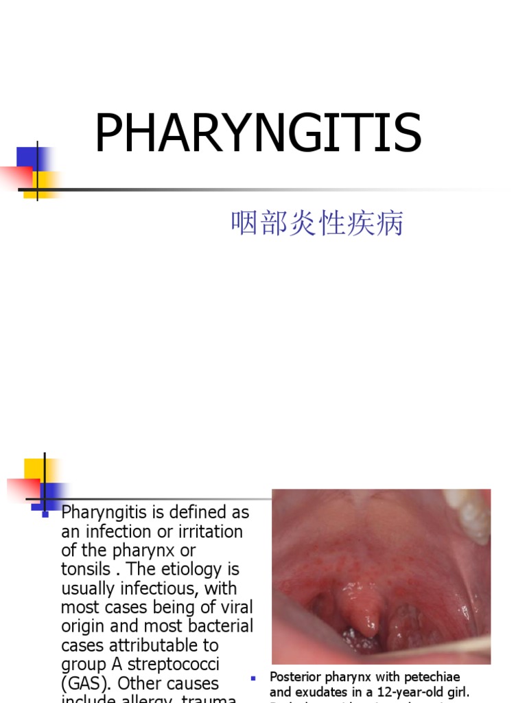 Concise Insights into Pharyngitis, Tonsillitis, and Adenoidal ...