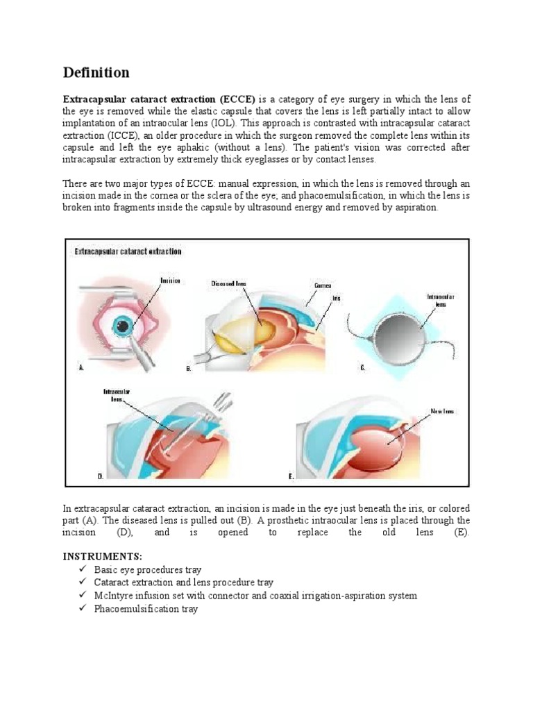 Cataract Extraction | Ophthalmology | Surgery
