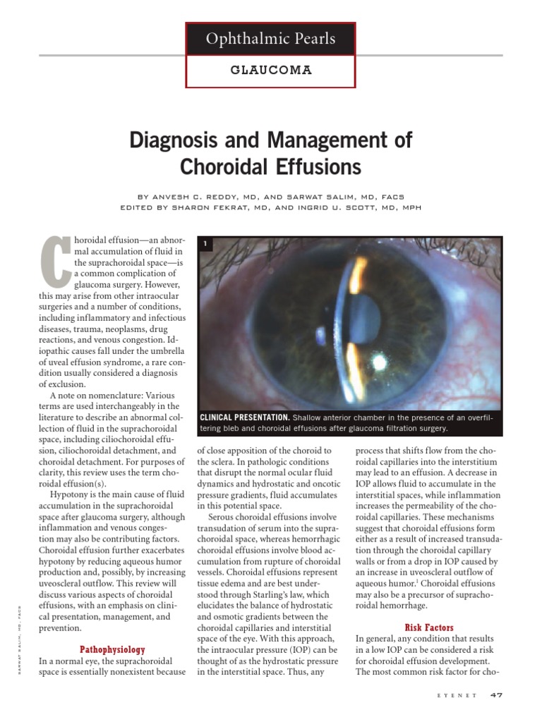 Ophthalmic Pearls - Choroidal Detachment | PDF | Glaucoma | Cataract