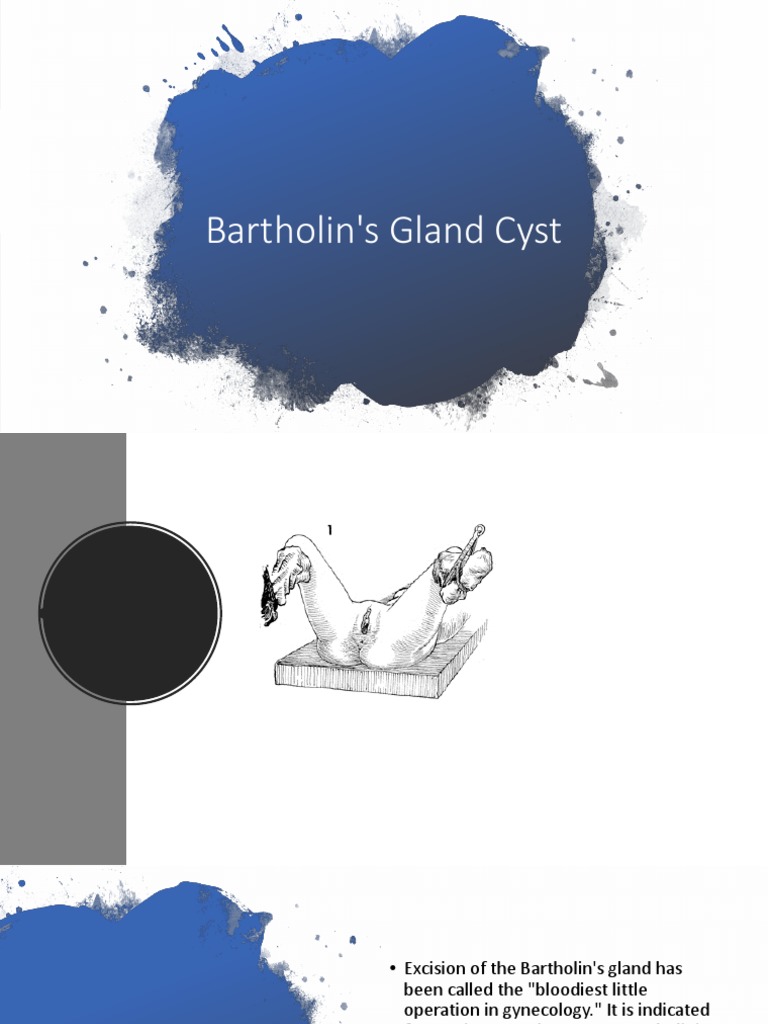 Bartholin's Gland Cyst | Download Free PDF | Vagina | Surgical Suture