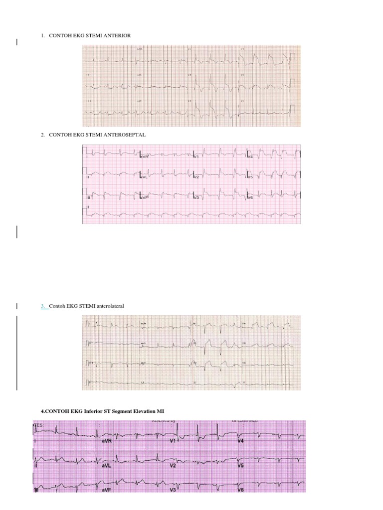 Contoh EKG STEMI Anteroseptal | PDF