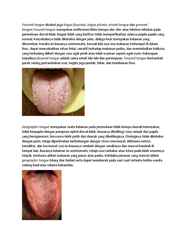 Fissured Tongue Disebut Juga Lingua Fissurata | PDF