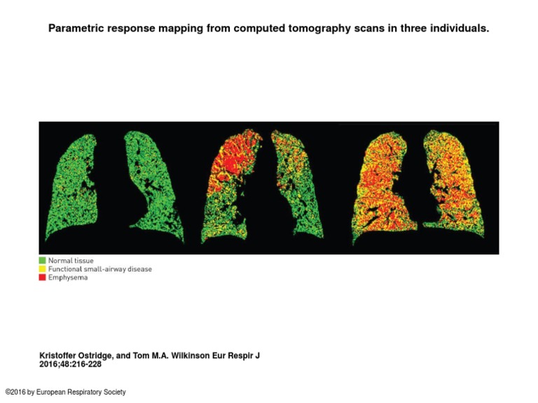 Parametric Response Mapping From Computed Tomography Scans in Three ...