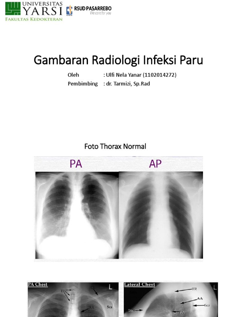 Gambaran Radiologi Infeksi Paru | PDF