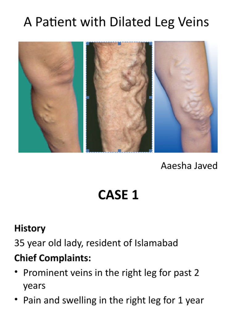 Dilated Leg Veins | PDF | Varicose Veins | Vein