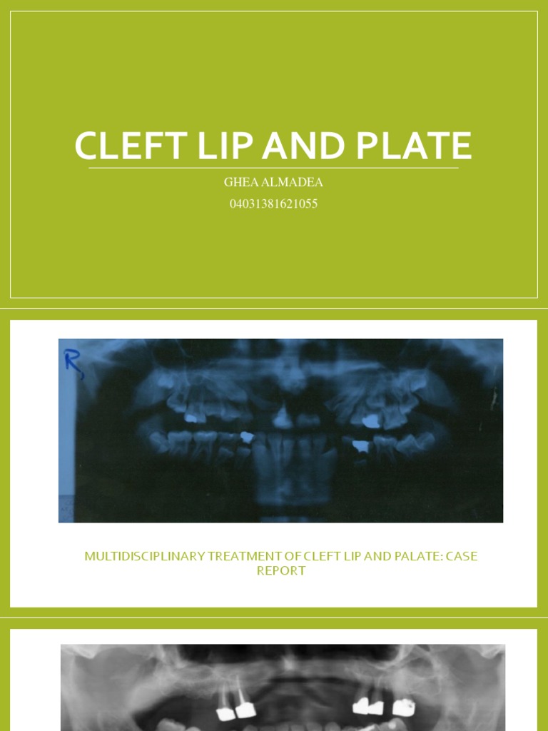 Cleft Lip and Plate | PDF