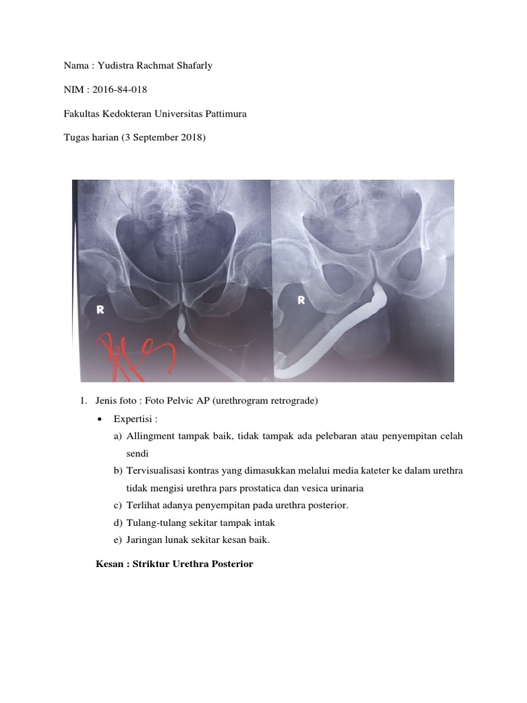 Striktur Urethra Post Dan Tof | PDF