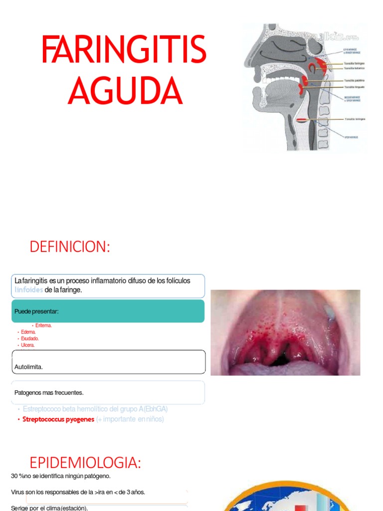 Faringitis aguda y crónica: definiciones, etiología, clínica ...