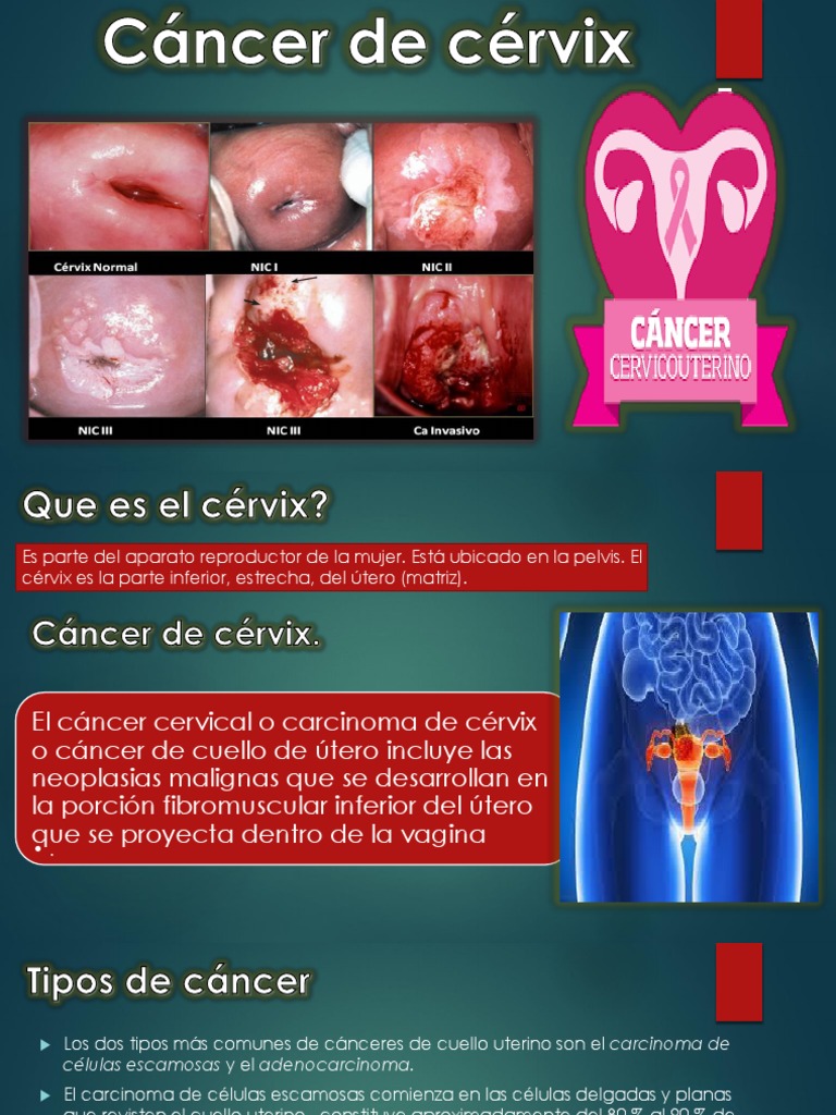 Cáncer de cuello uterino: tipos y diagnóstico | PDF | Cáncer de cuello ...