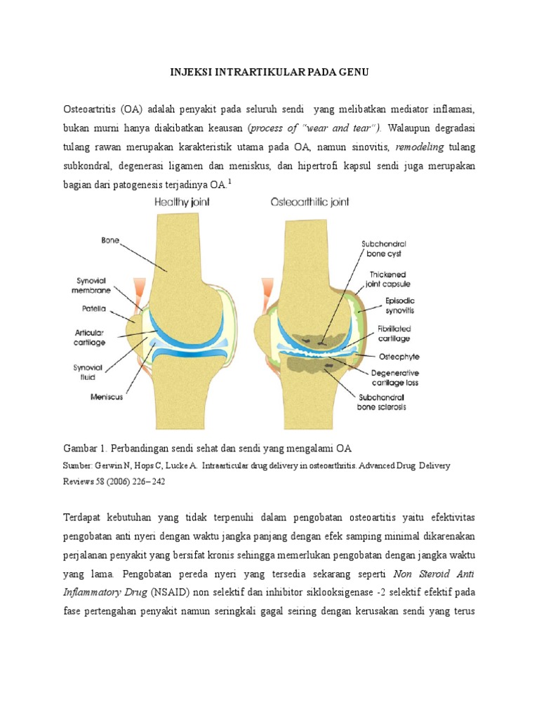Injeksi Intraartikular Pada OA-2015 | PDF